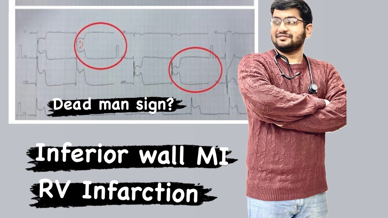 Mastering ECG:Lesson#7 IWMI + RV infarct ECG discussion - YouTube