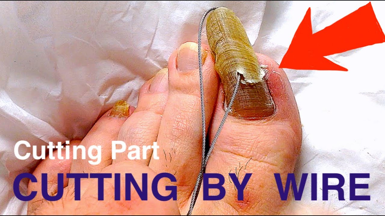 crazy! TOENAIL cut with wire (sicknail) cutting part - YouTube