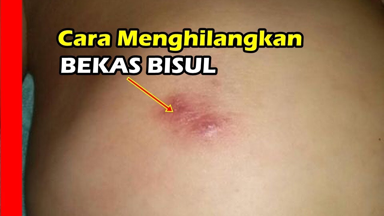 6 Cara Menghilangkan Bekas Bisul dengan Mudah! - YouTube
