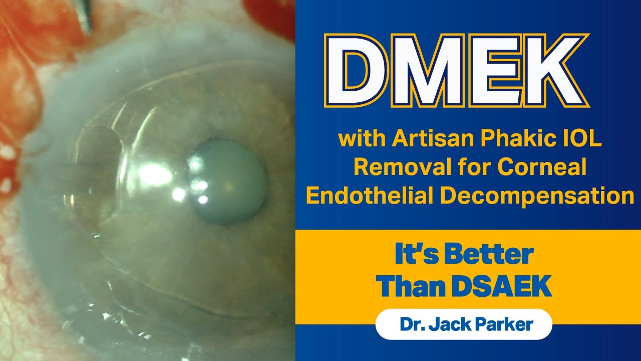 DMEK with Artisan Phakic IOL Removal for Corneal Endothelial ...