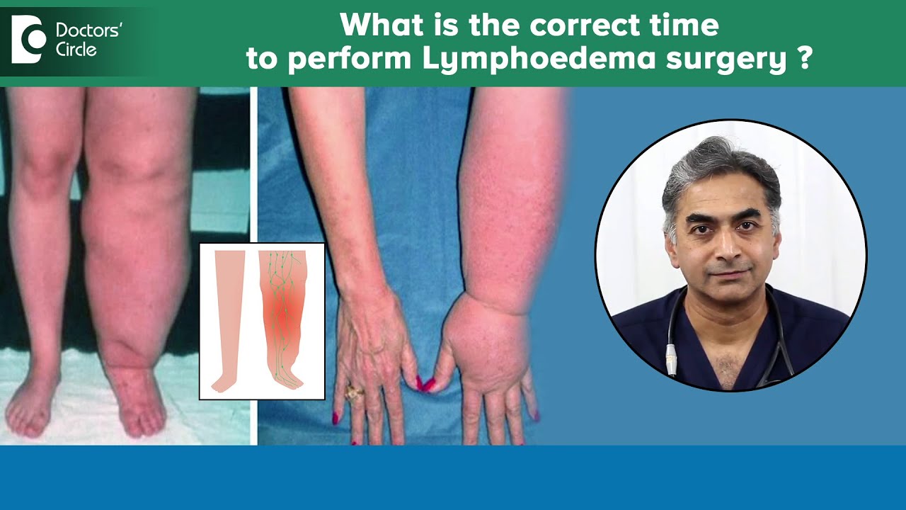 How to reduce Swelling in hand and feet with Lymphoedema Surgery? - Dr ...