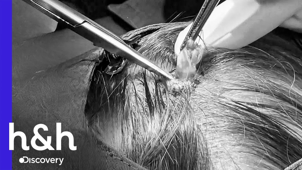 Extracción de 4 quistes pilares de la cabeza | Dra. Sandra Lee ...