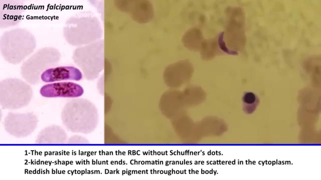 25- Practical Parasitology - Plasmodium Falciparum - Gametocyte Stage ...