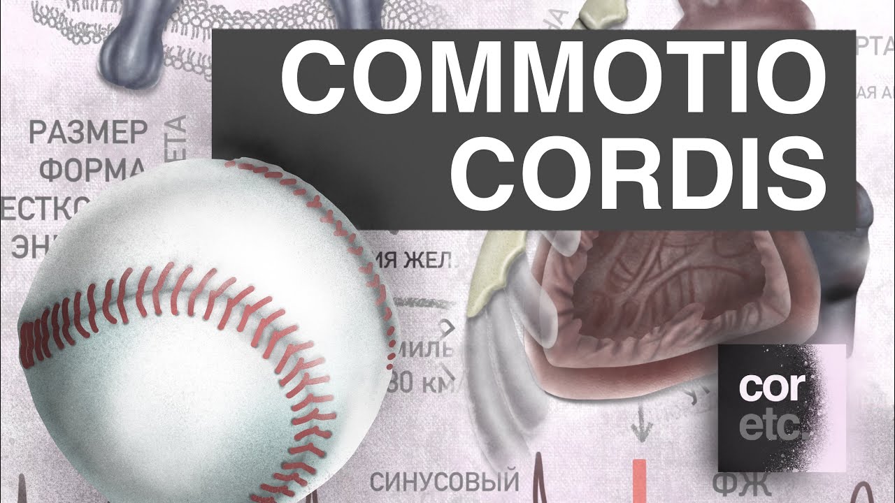Commotio cordis (сотрясение сердца). - YouTube