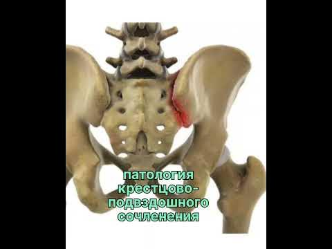Причины синдрома грушевидной мышцы - YouTube