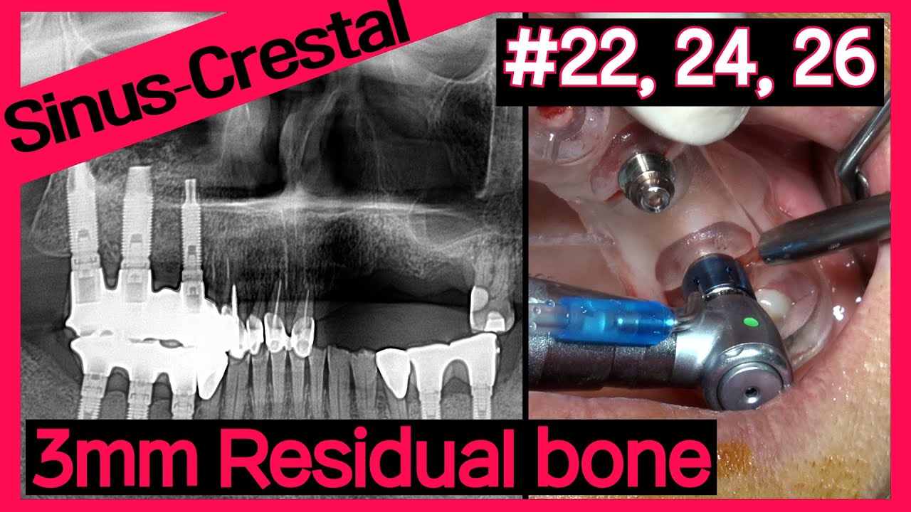 [Online Surger] #26 Implant using OneCAS on 3mm residual alveolar bone ...