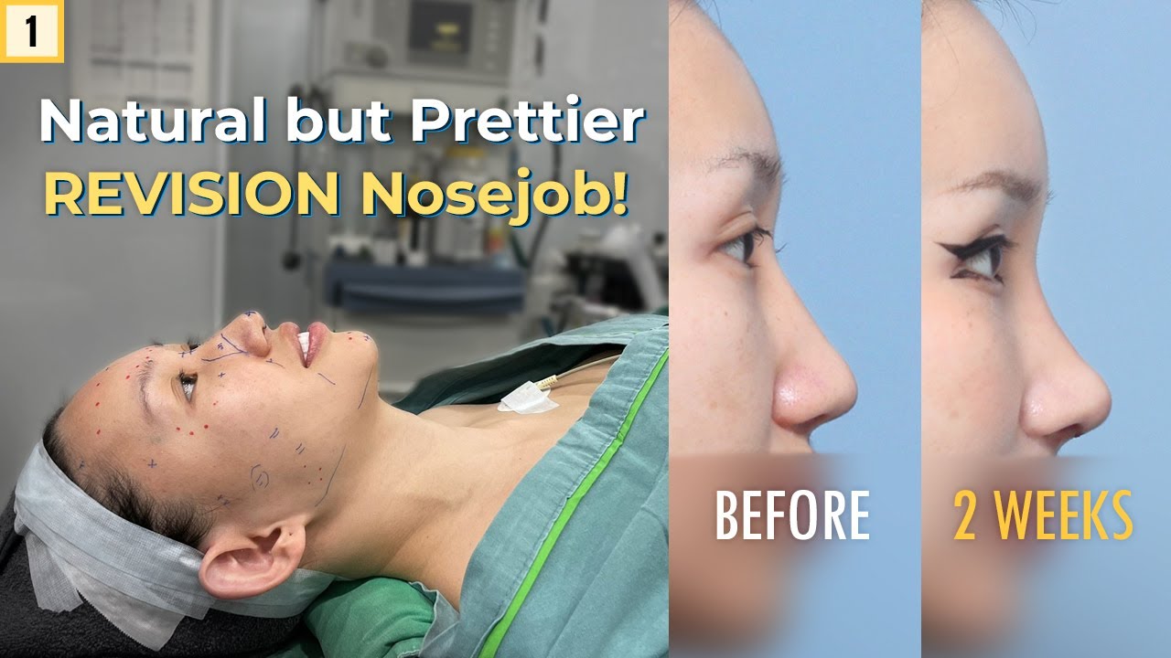 [SUB] Revision Rhinoplasty, Fat Grafting, and Thread Lifting for a More ...