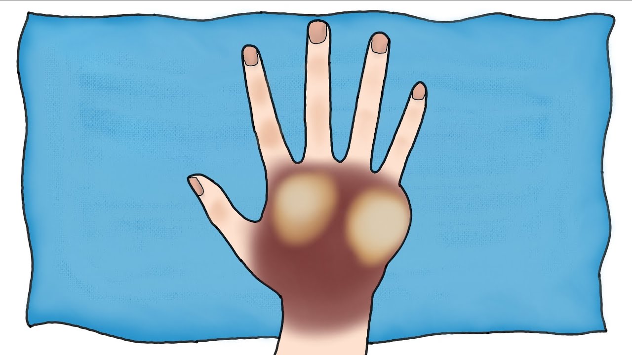 Asmr animation cleaning infected hand - YouTube