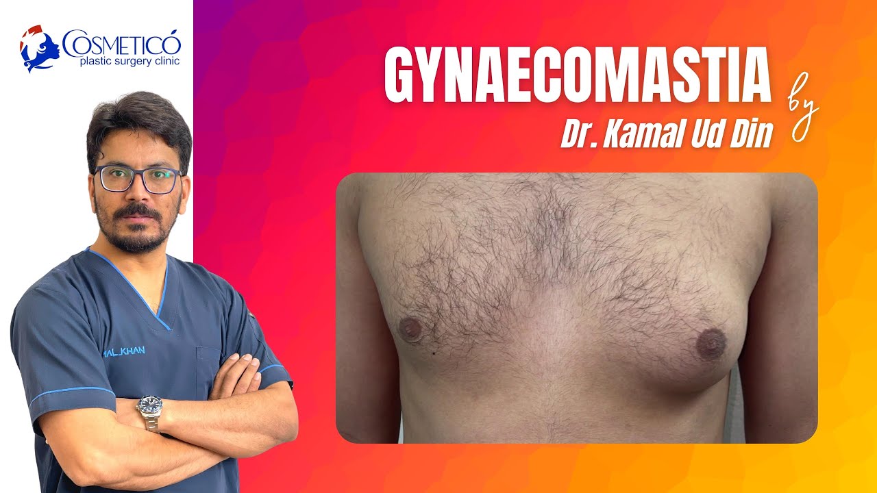 GYNECOMASTIA: Bilateral Gland Removal Surgery | Dr. Kamal Ud Din Khan ...