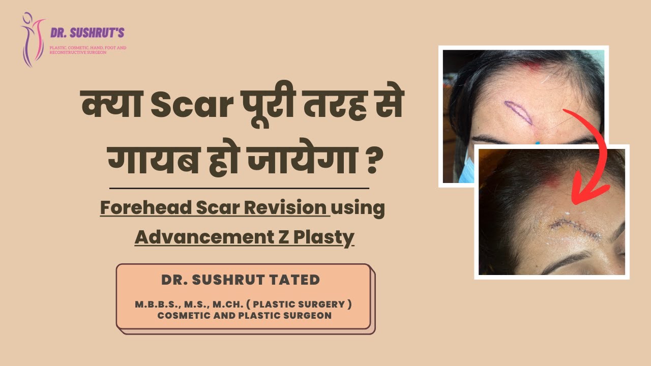 Forehead Scar Revision using Advancement Z Plasty by Plastic Surgeon ...