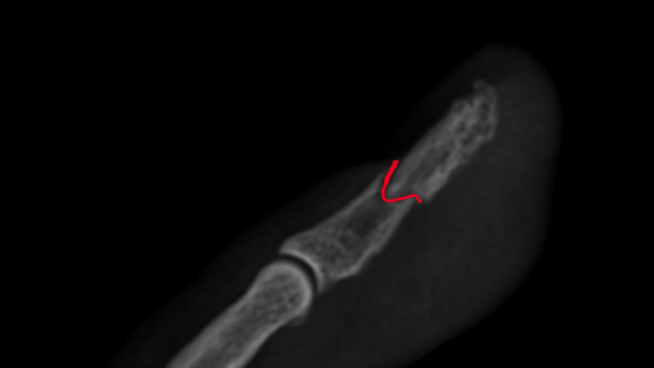 Little Finger Fracture (Xray 18) - YouTube