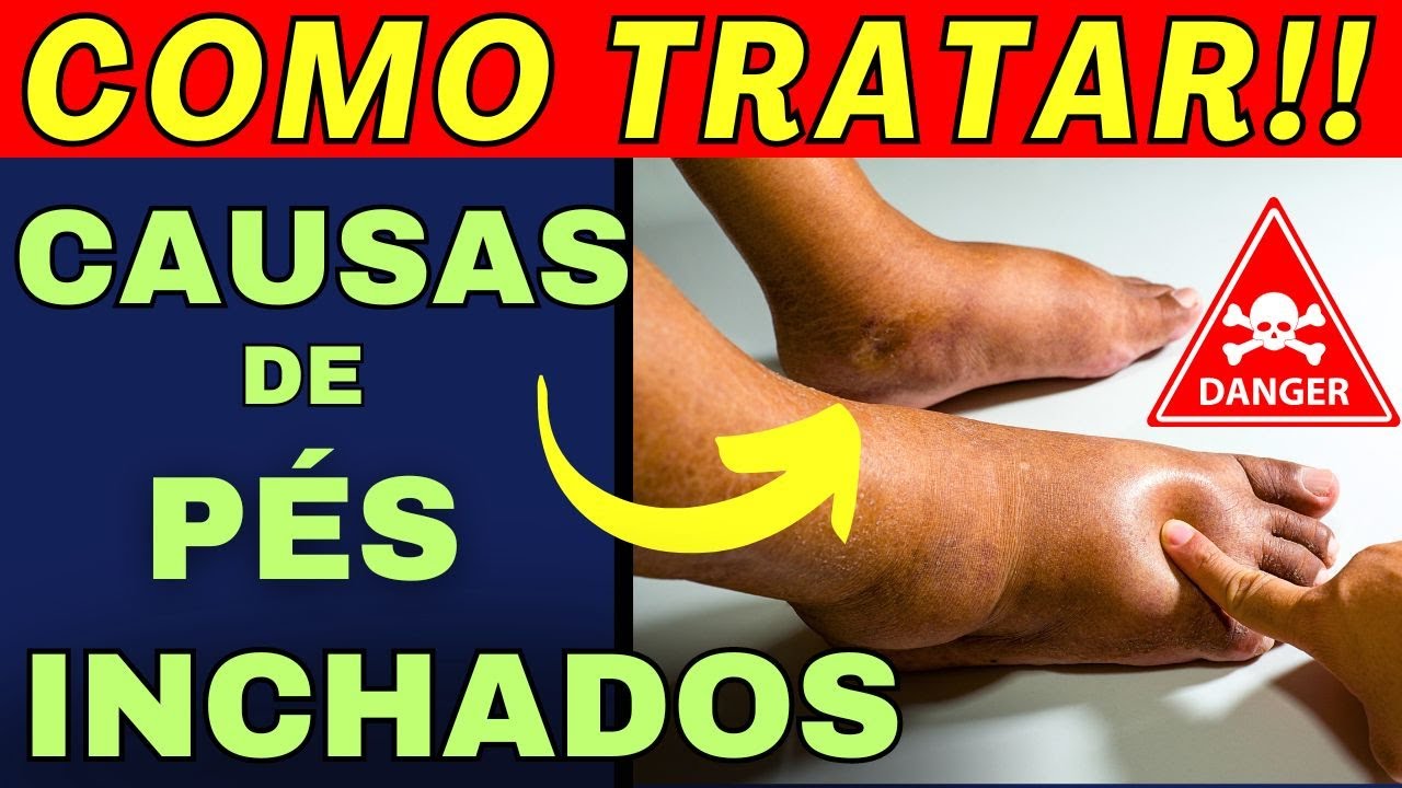PÉS INCHADOS Causas e tratamentos de inchaço nos pés e pernas - COMO ...