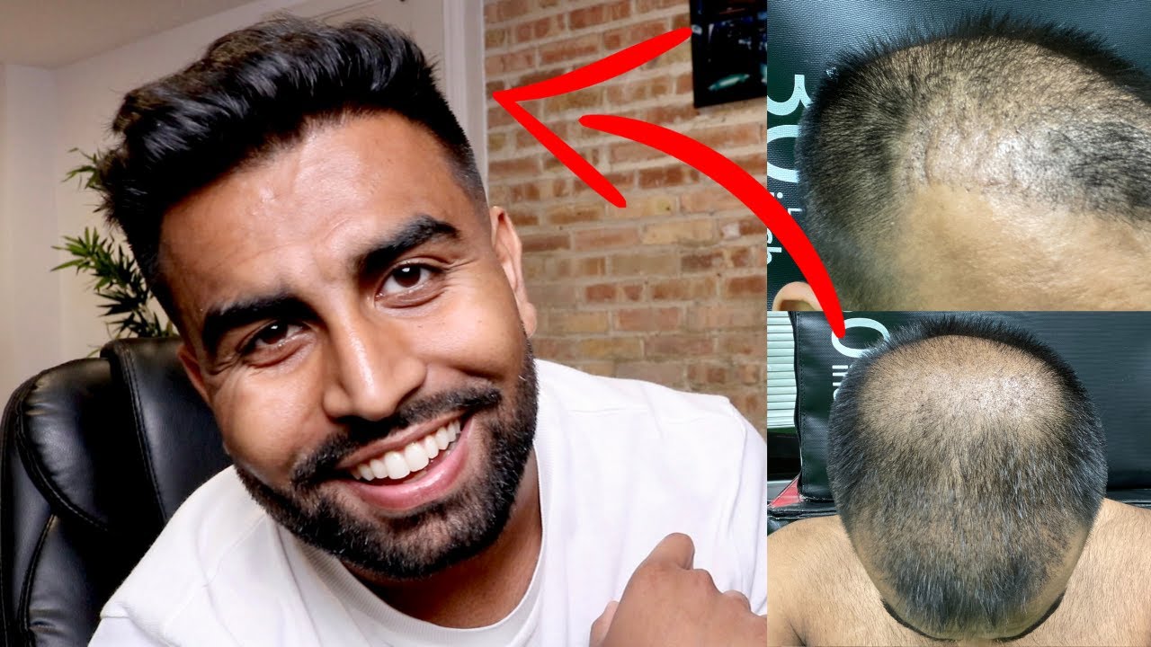 7 MONTH TURKEY HAIR TRANSPLANT UPDATE | PHASE 2 - YouTube