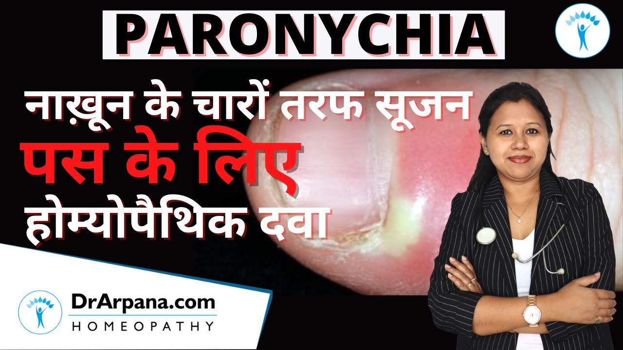 PARONYCHIA नाख़ून के चारों तरफ सूजन व पस की दवा || PANARITIUM Role of ...