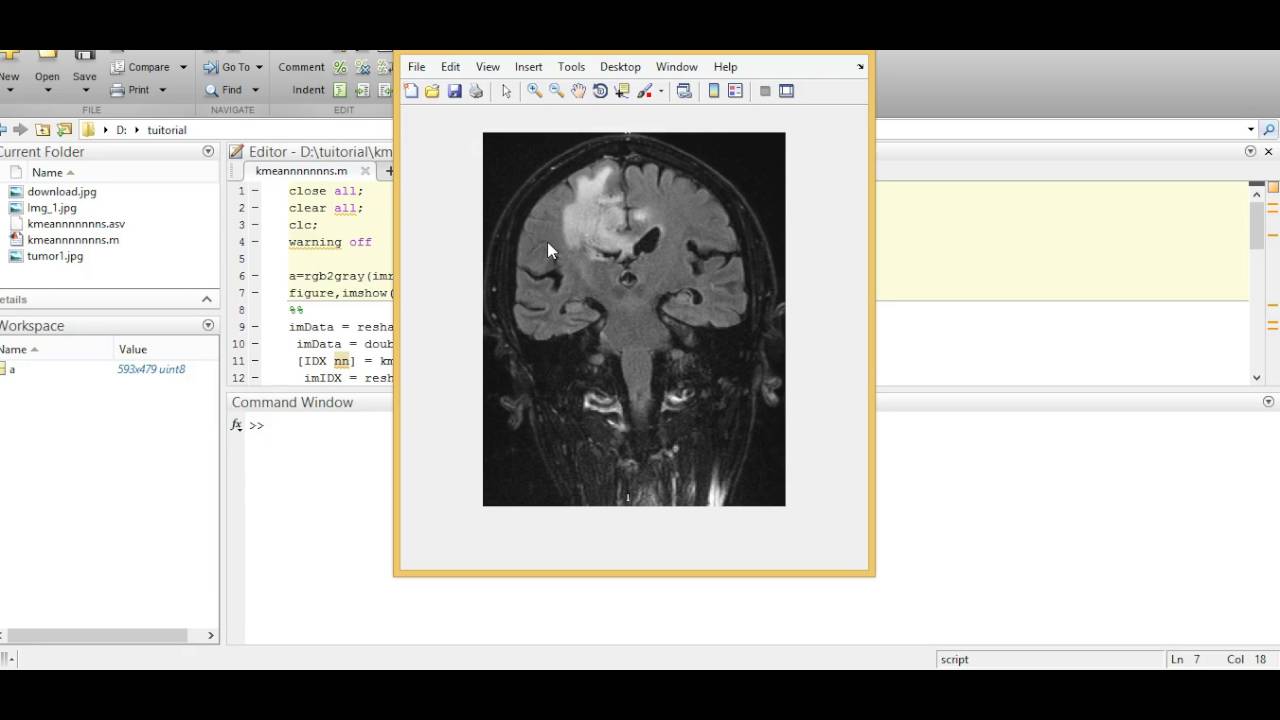 Brain Tumor Segmentation Using K Means Algorithm Youtube