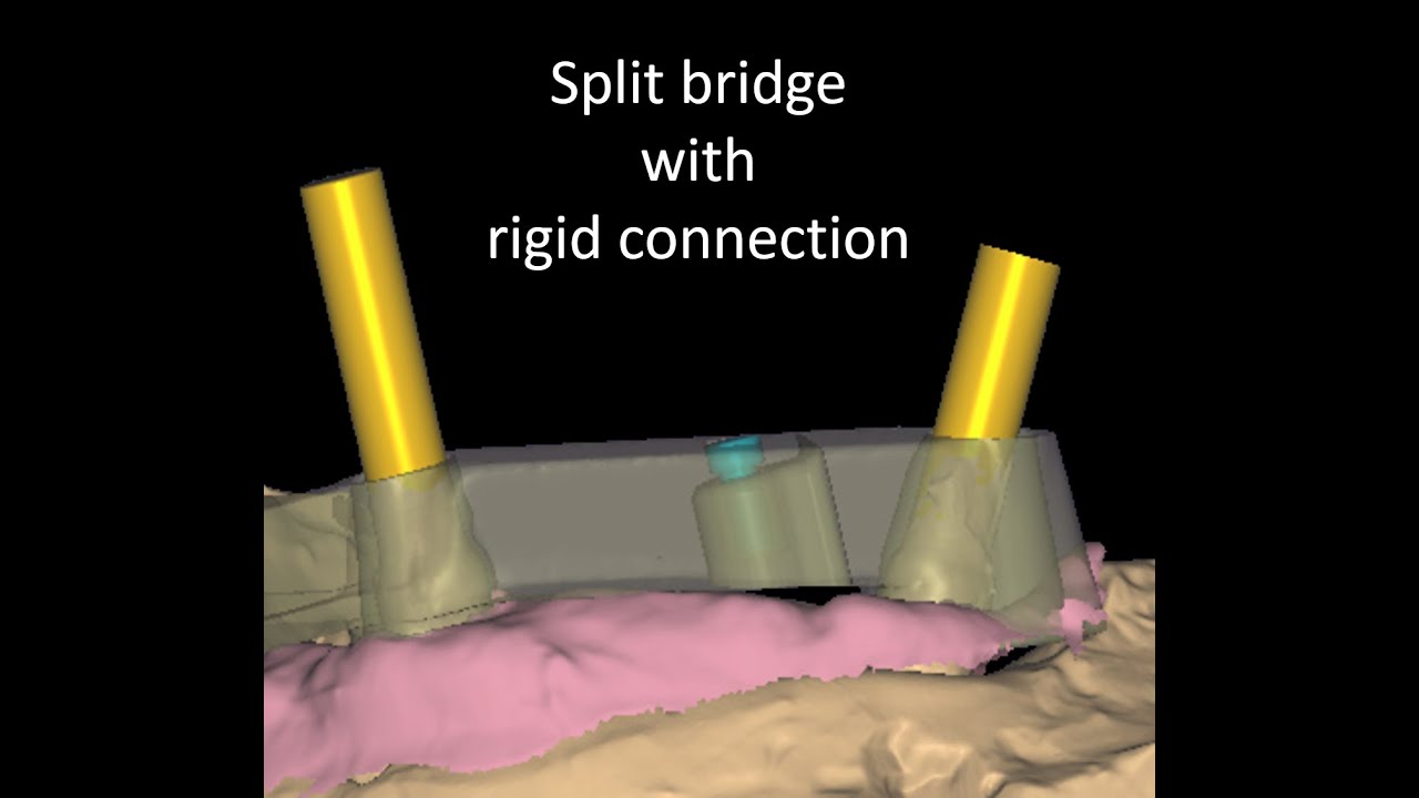 Split bridge with rigid connection - YouTube