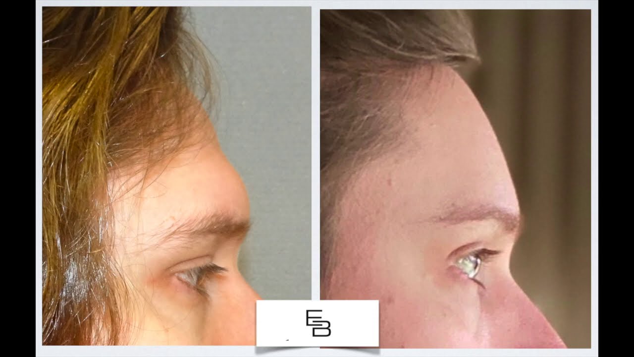 Type 3 fronto-orbital recontouring exclusive technique by Dr Eric ...
