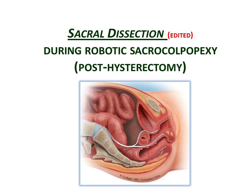 Sacral Dissection During Robotic Sacrocolpopexy Youtube