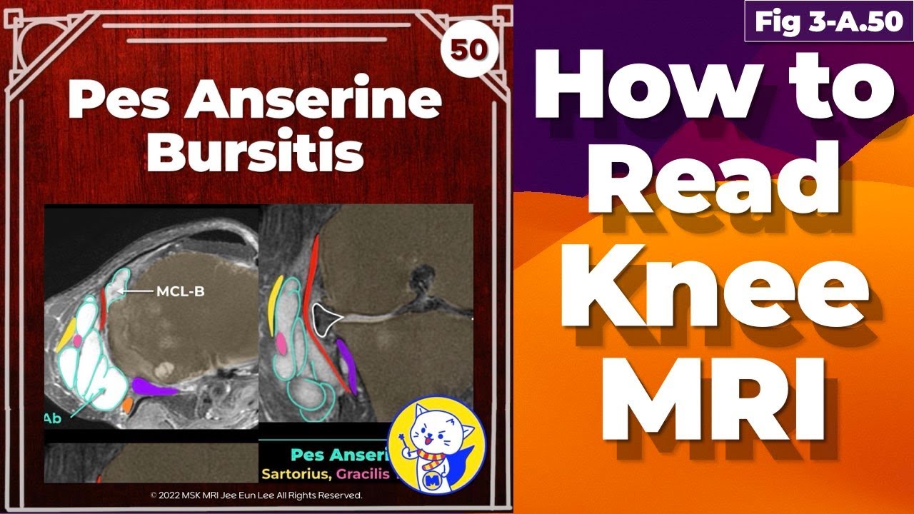 (Fig 3-A.50) Pes Anserine Bursitis - YouTube