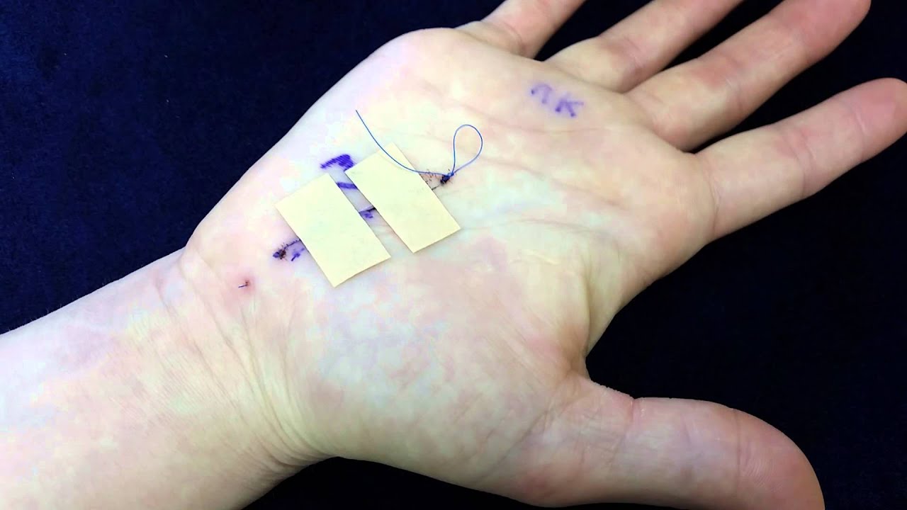 Milwaukee Hand Center Subq Suture Removal Youtube