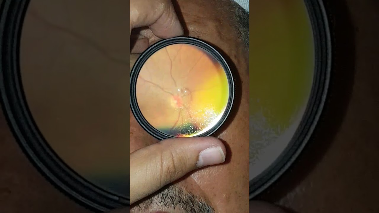 Weiss ring by smartphone fundus photography - YouTube
