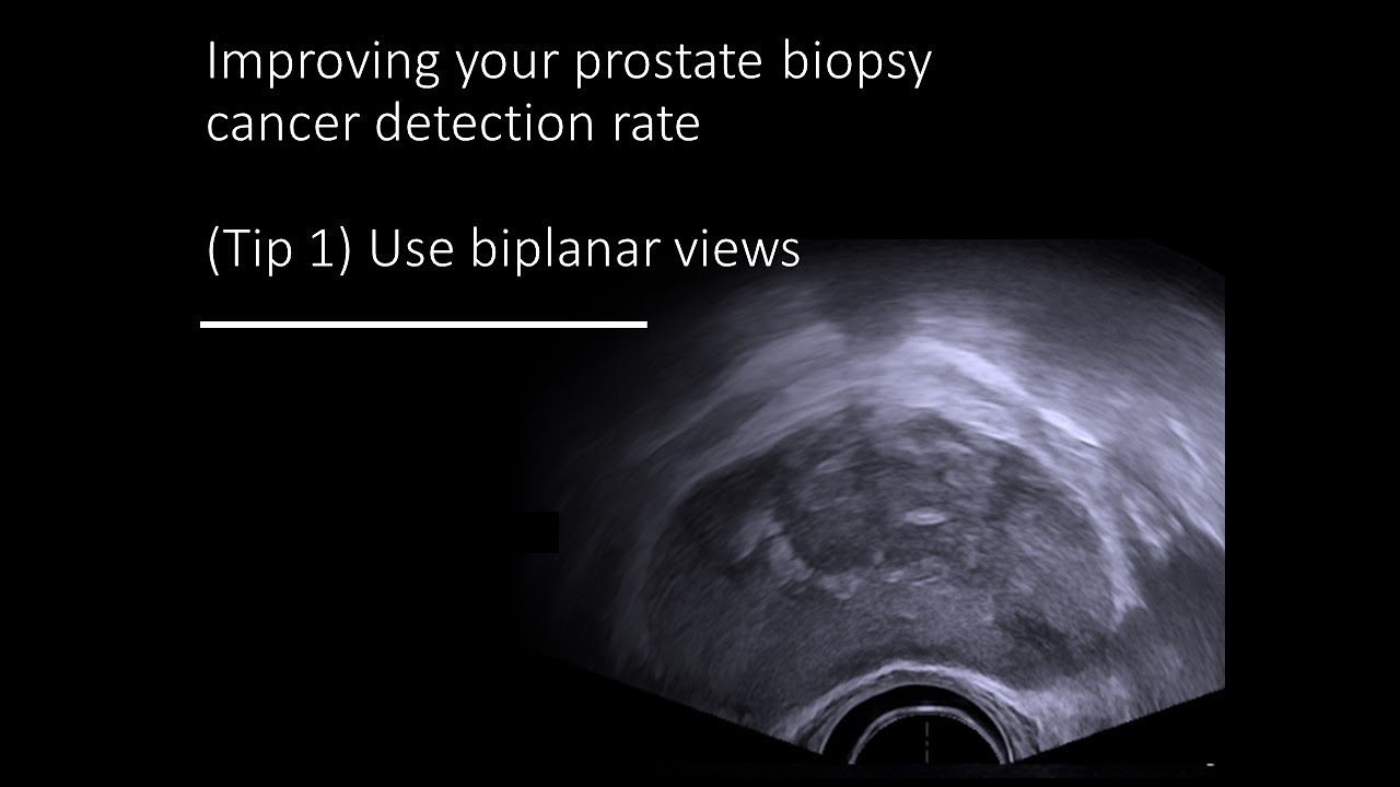 Improving cancer detection during freehand transperineal prostate ...