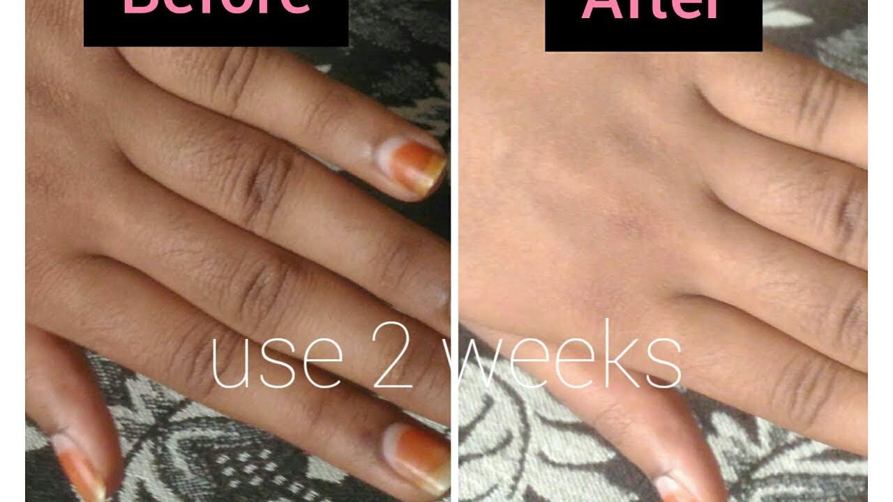 Skin whitening in 2 weeks - YouTube