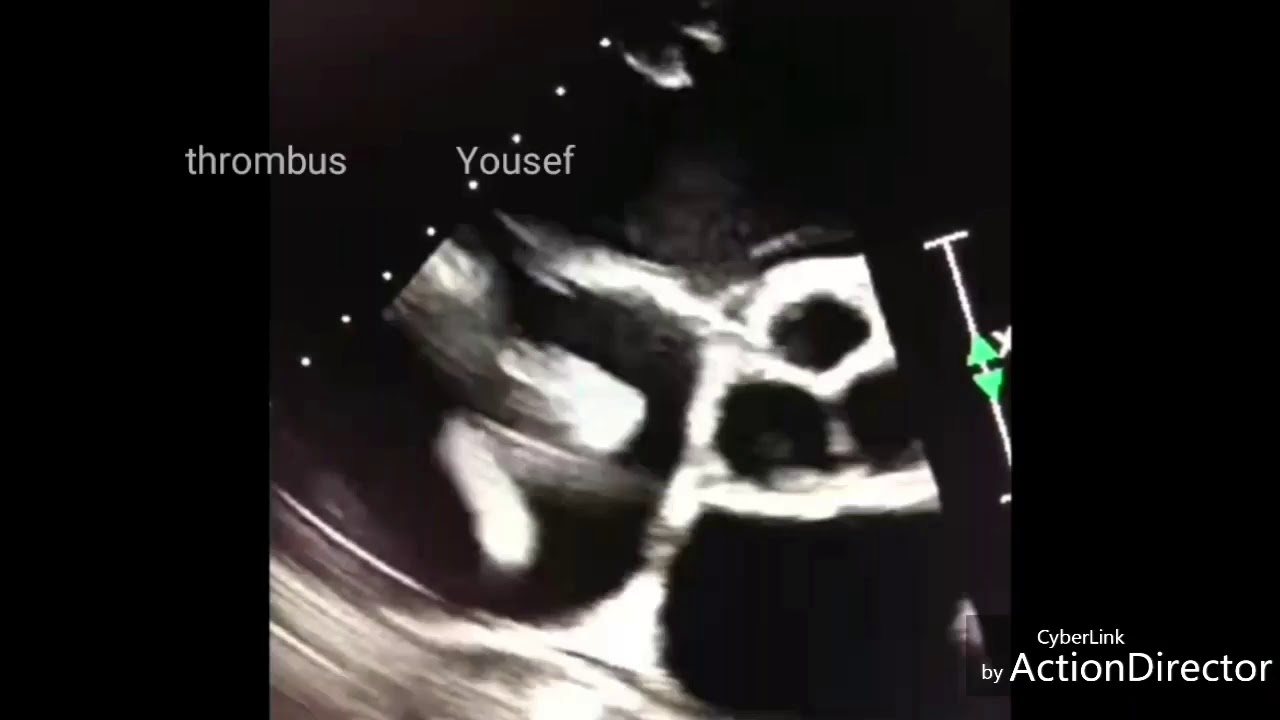 Rt atrial thrombus echocardiography video - YouTube