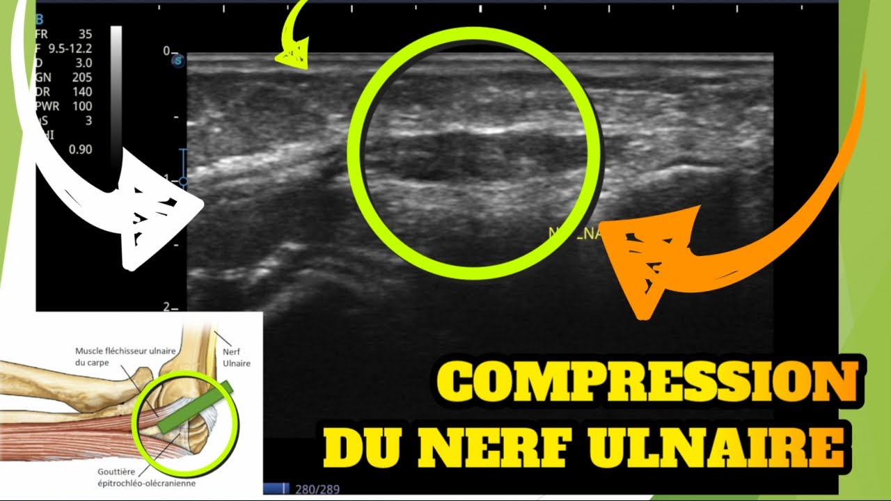 Echographie du nerf ulnaire au coude: compression? - YouTube