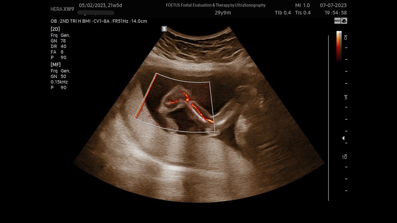 Monoamniotic Twin with Body Stalk Anomaly and Amniotic Entrapment - YouTube