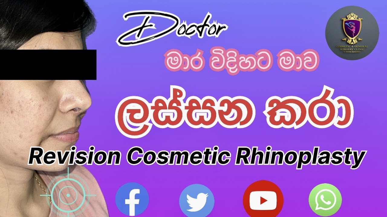 Doctor මාර විදිහට මාව ලස්සන කරා Revision cosmetic rhinoplasty Nose job ...