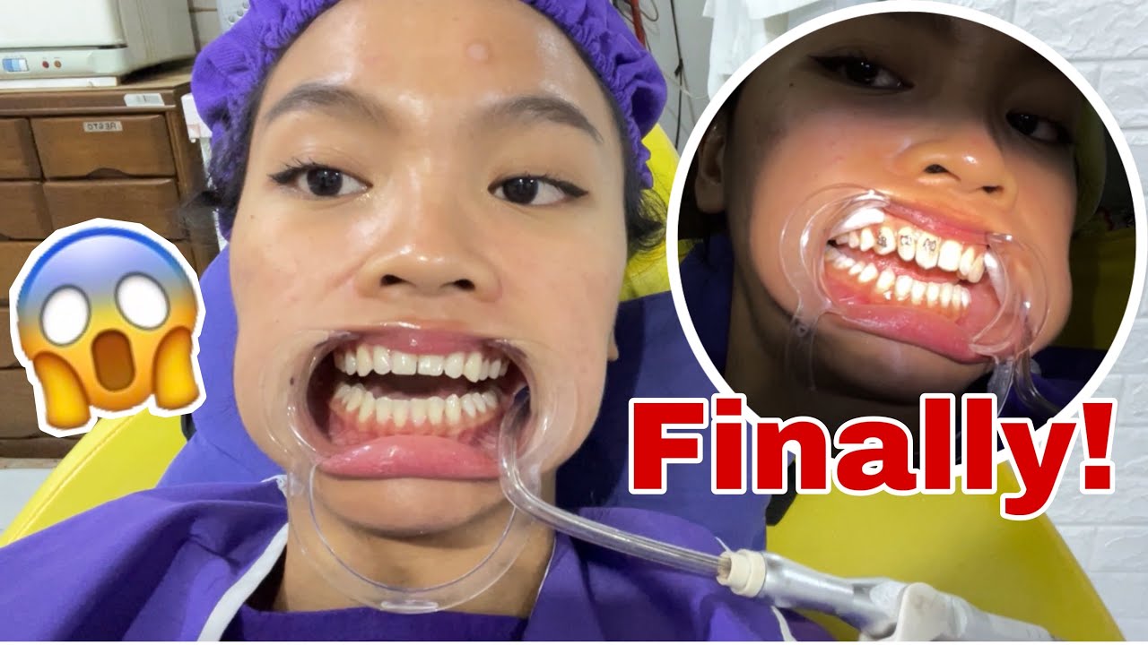 ITO NA! TEETH MAKEOVER! VEENERS OR BRACES?! - YouTube