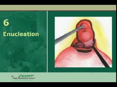 Cirurgias Videolaparoscópicas - Laparoscopic Simple Prostatectomy René ...