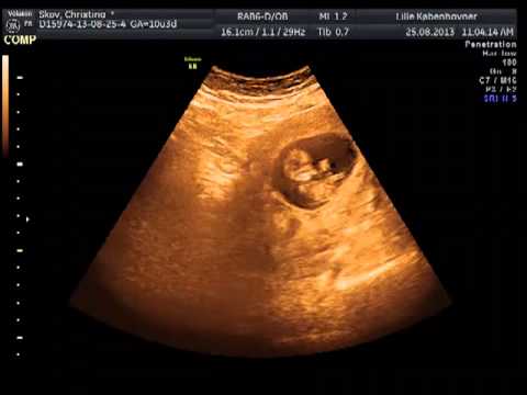 Baby scan week 10 days 3 - YouTube