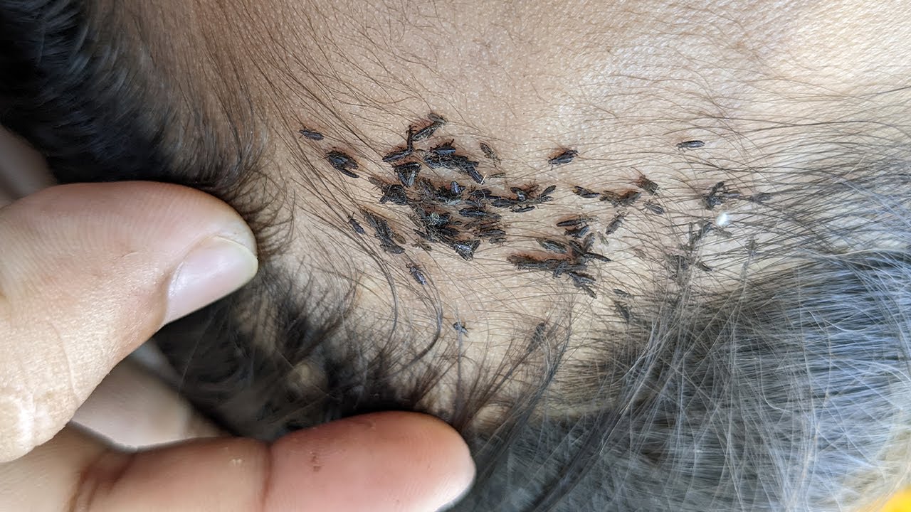 How to clear a lot of head lice from long hair - Get out some head lice ...