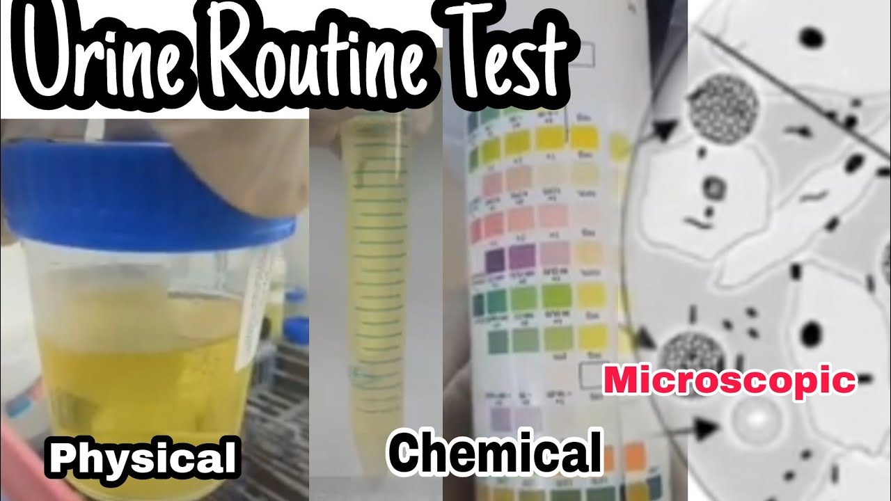 Urine Routine Test | Urine Analysis | Chemical Physical and Microscopic ...