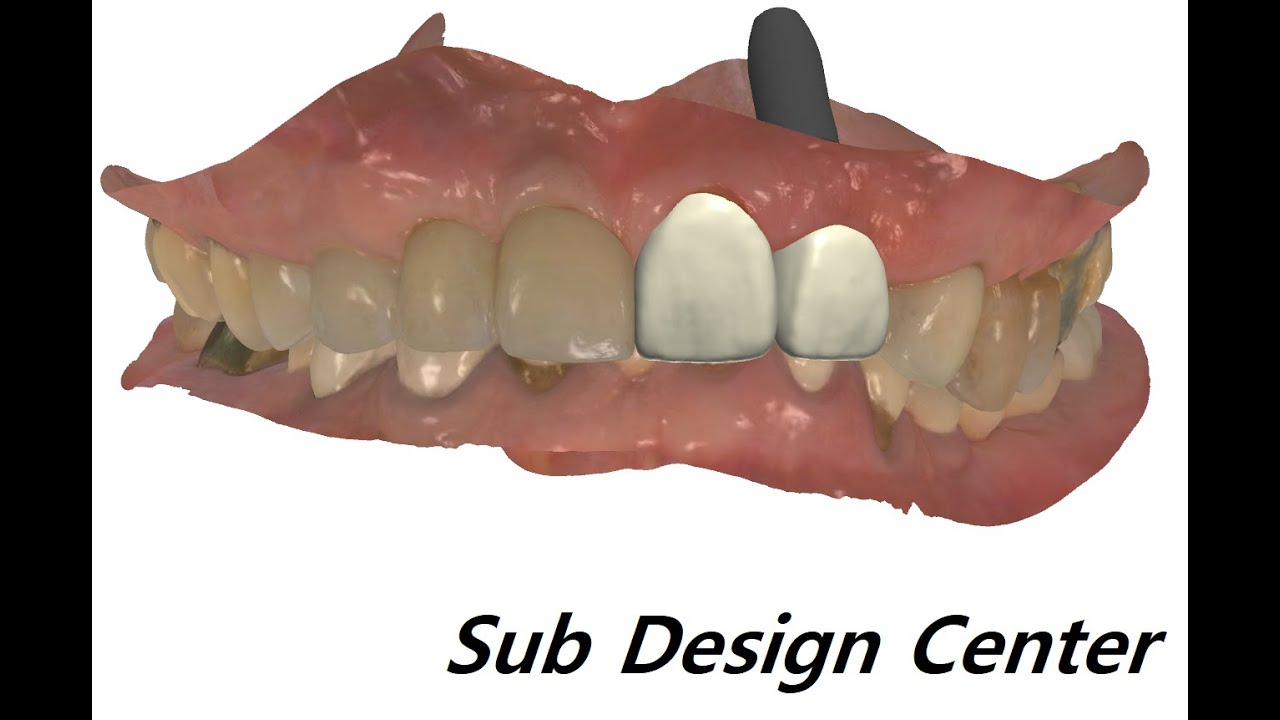 3shape design (anterior teeth 😬 implant case) // 전치부 간단한 케이스 디자인 임플란트 ...