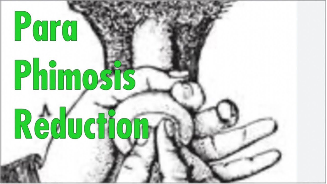 Paraphimosis Reduction Surgery by Dr C Sharath Kumar, Sexologist ...