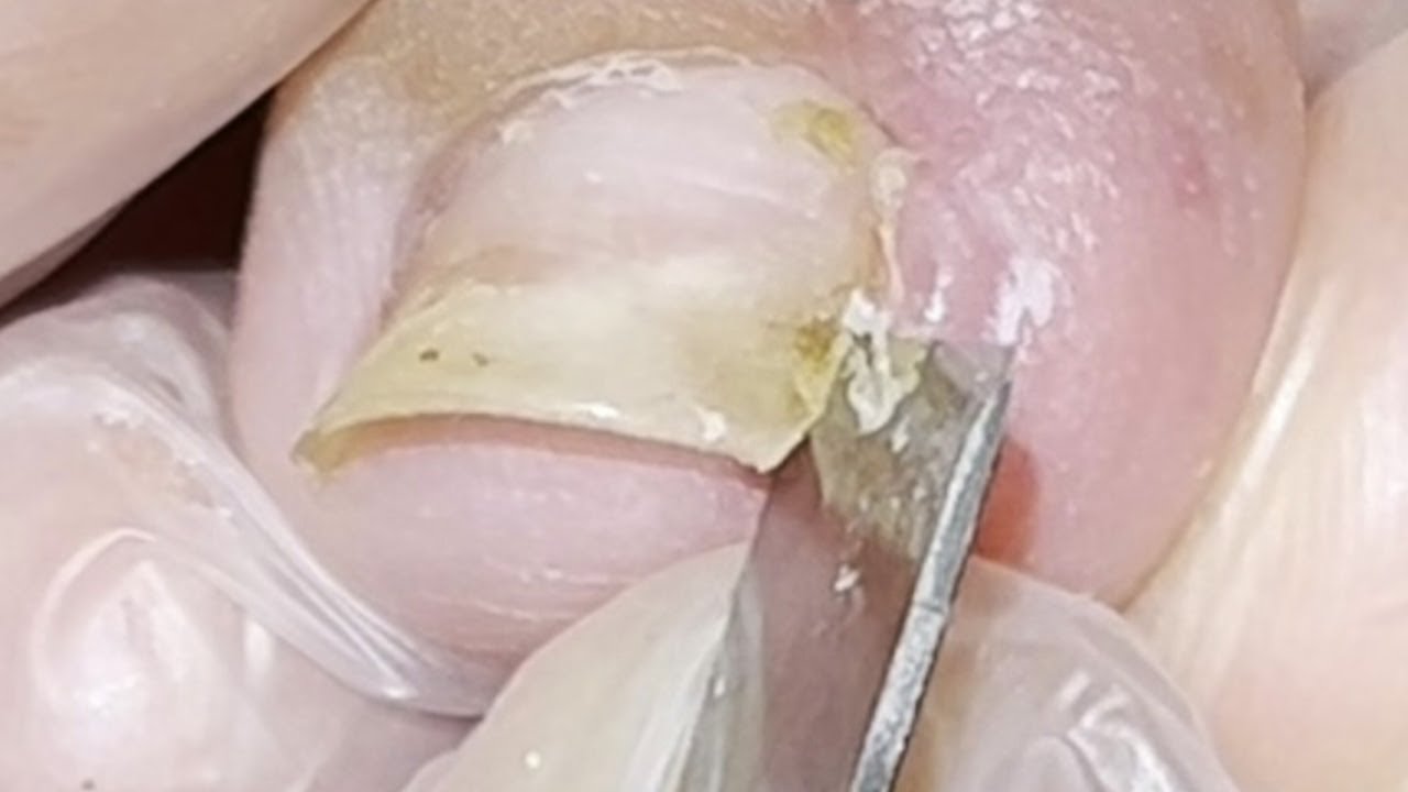 PEDICURE：super long sharp toenails【Pedicure Brother – Awei】 - YouTube