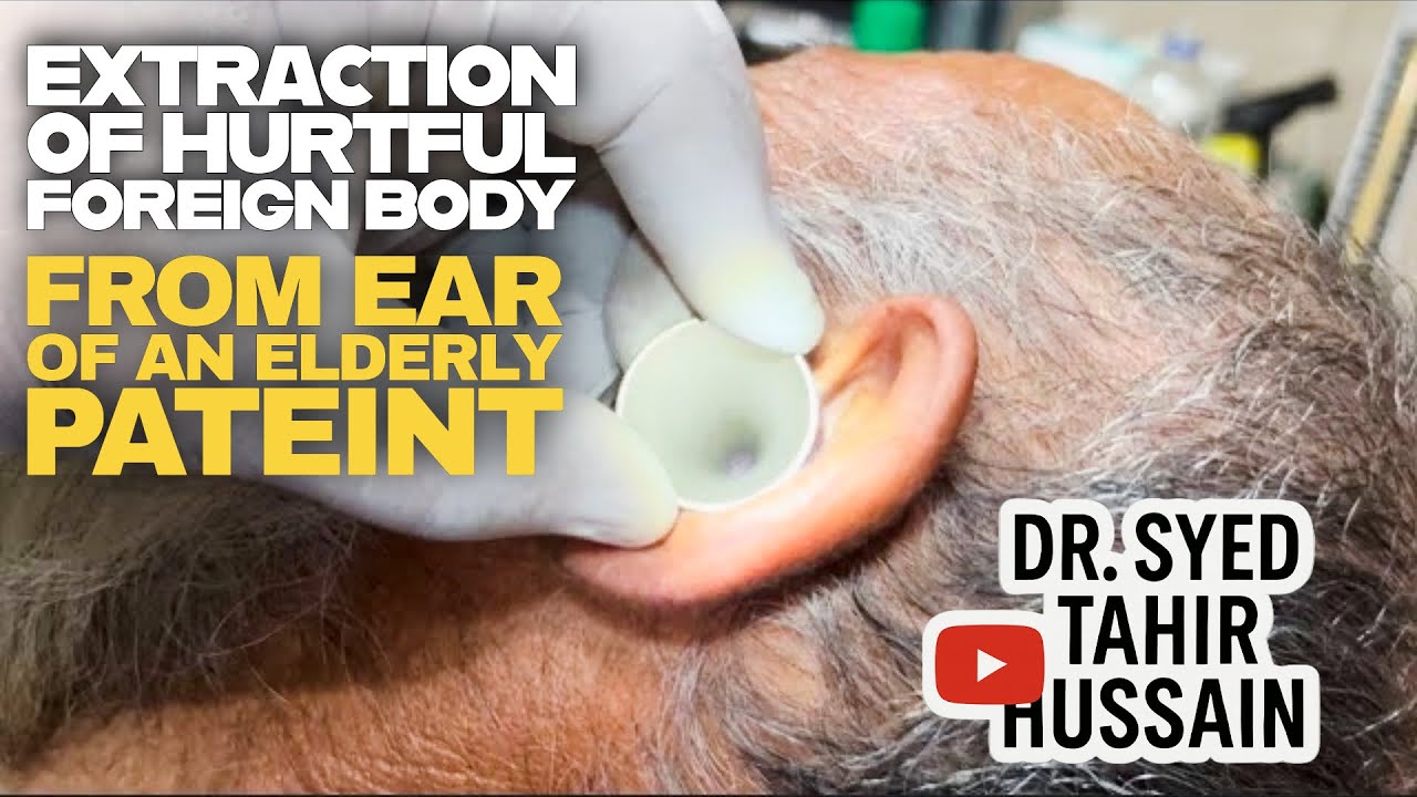 Hurtful Foreign Body Causing Hearing Impairment and Pain Extracted ...