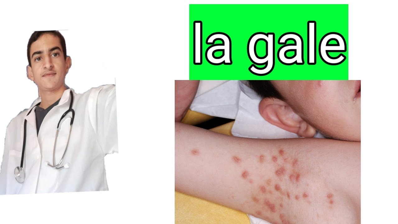 la gale (Sarcoptes scabiei) - YouTube