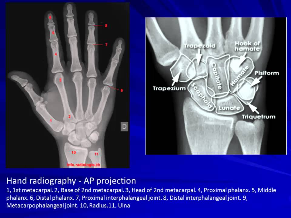 13 CT Anatomy of hand - YouTube