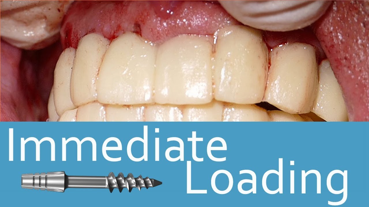 Immediate loading on Compressive and Basal implants - YouTube