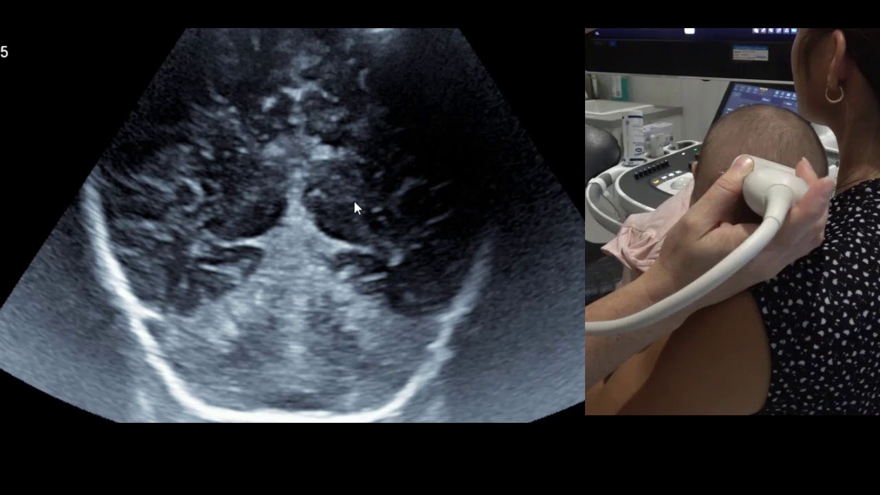 Paediatric Head/Brain ultrasound - 101 Pattern recognition - YouTube