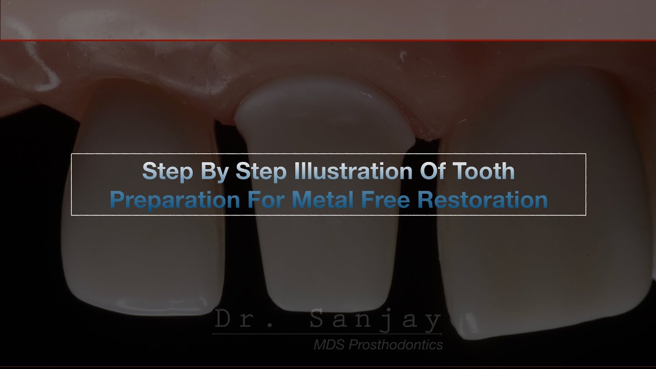 Tutorial on Simplified anterior tooth preparation - YouTube