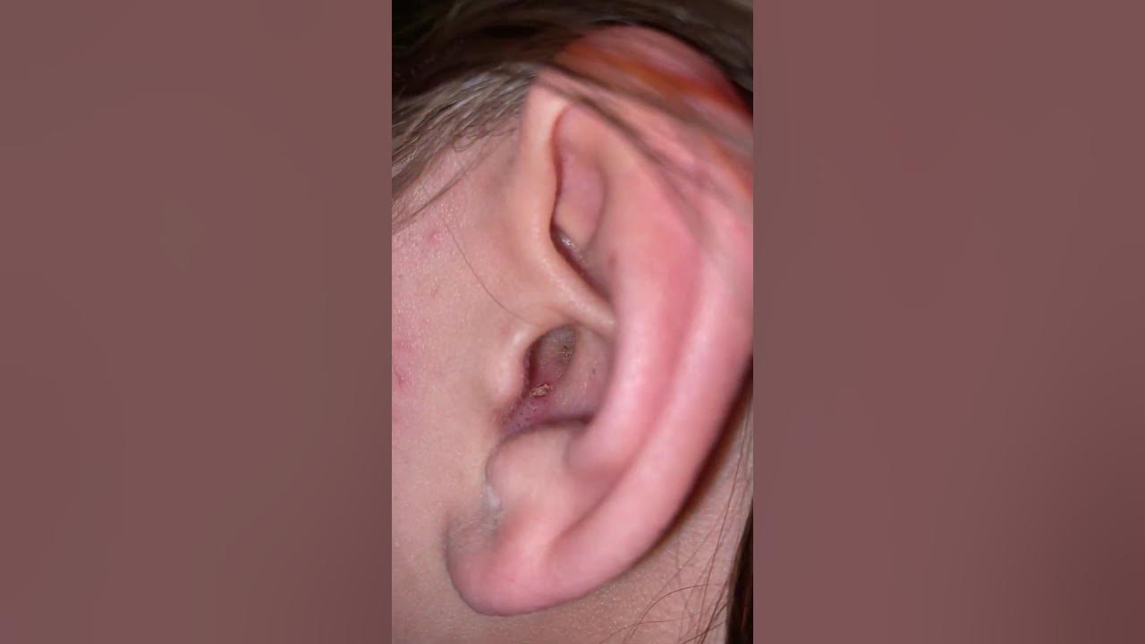 Oddly Satisfying Blackhead Extraction In Ear With Tweezers Youtube
