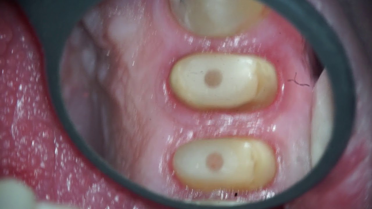 VERTICAL TOOTH PREPARATION TEMPORARY CROWNS - YouTube