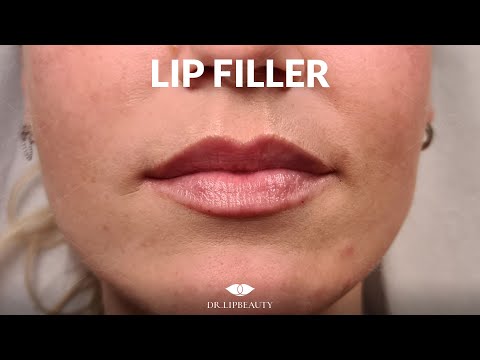Filler labbra Acido Ialuronico Dr Lipbeauty