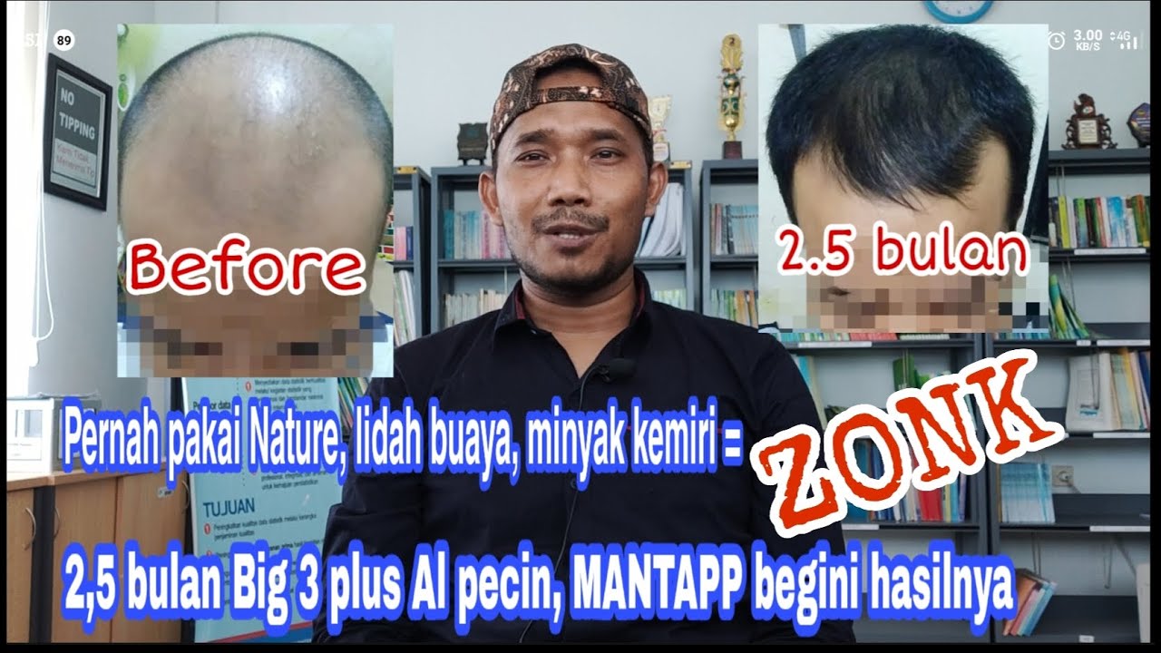 hasil 2.5 bulan menumbuhkan rambut botak. Profil Om Yuda - YouTube