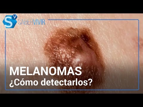 Tipos De Lunares Fotos • TIPOSDE